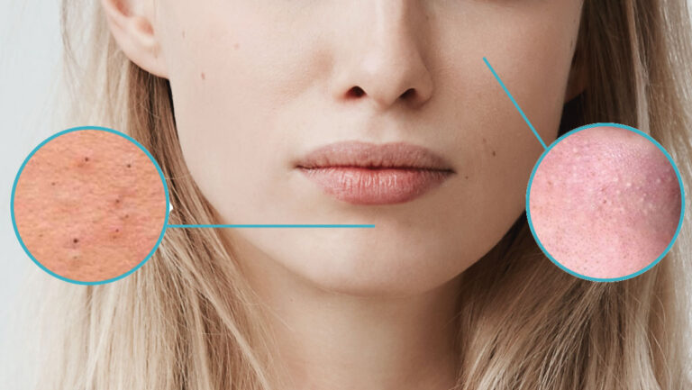 Acnee usoara sau acnee comedoniana | Dr. Teodora Predescu